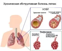 Penyakit paru obstruktif kronis