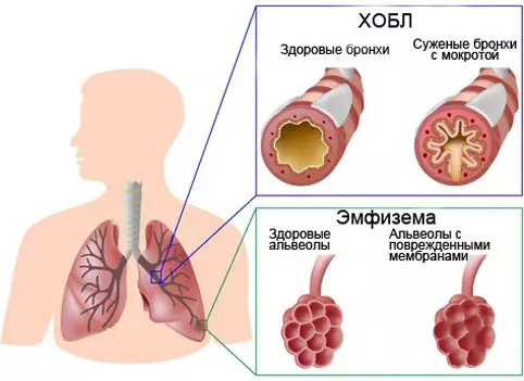 නිදන්ගත බාධාකාරී පෙනහළු රෝගය