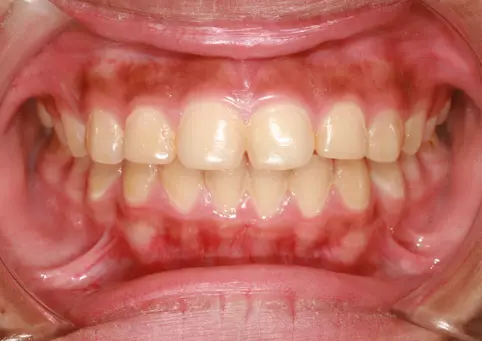 Periodontitis