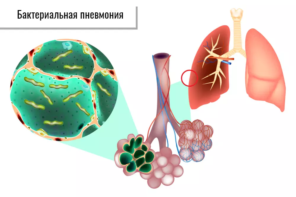 Sebhelyes fertőzés: hogyan védekezzünk a tüdőgyulladás ellen 8448_2