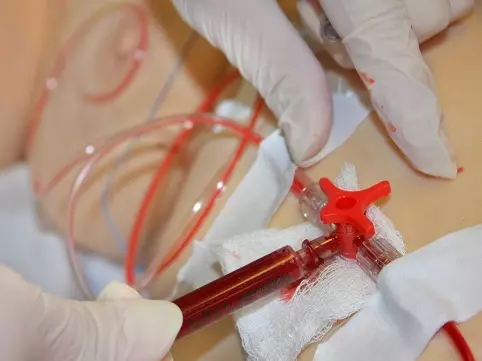 ניתוח גז דם עורקי - מדריך לשיטות אבחון 84554_1