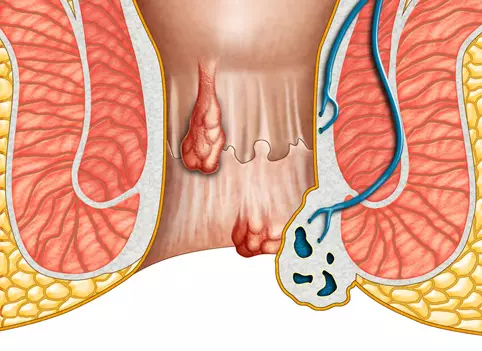 Wie behandelt man Hämorrhoiden