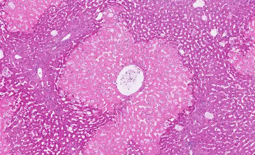 Biopsia do miocardio: unha guía de métodos de diagnóstico 85340_1