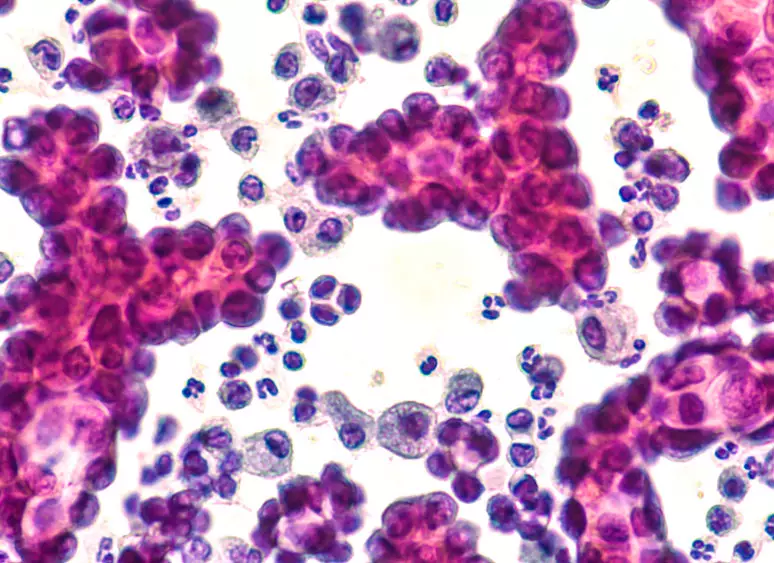 બિન-નાના સેલ ફેફસાના કેન્સર (NSCLC) ના પ્રારંભિક અને સ્થાનિક રીતે અદ્યતન તબક્કાઓ