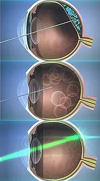 Stakkament tar-retina 8573_6