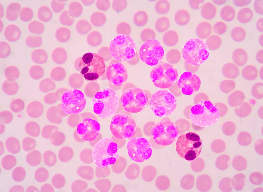 Chronyske myeloide leukemy (CML) 8595_1