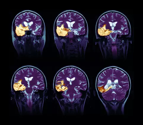 Encephalitis: sebab, diagnosis, rawatan 86138_1