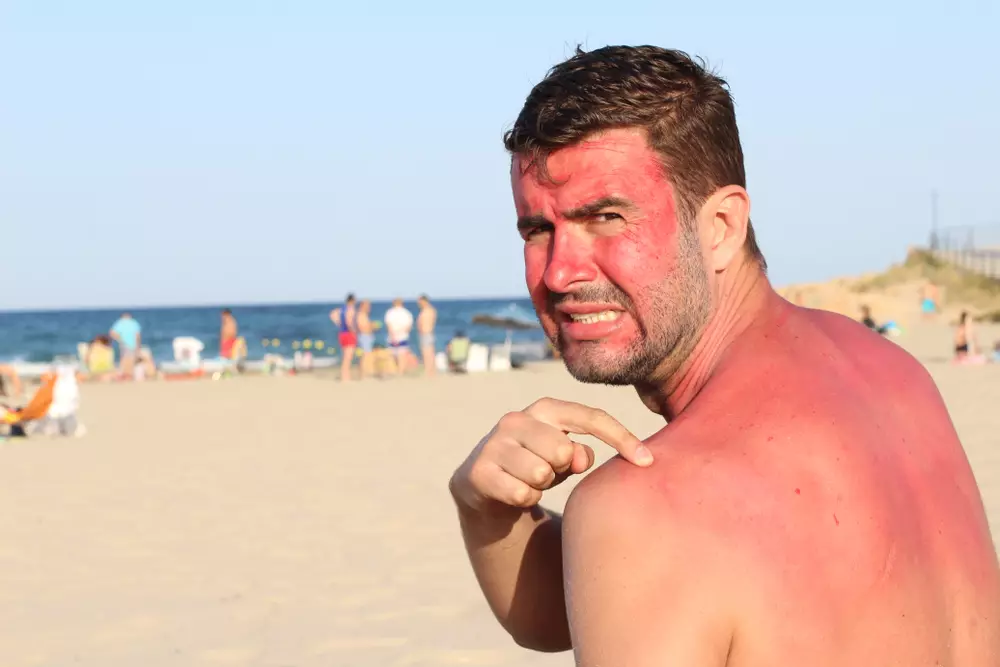 Sunburn and its consequences