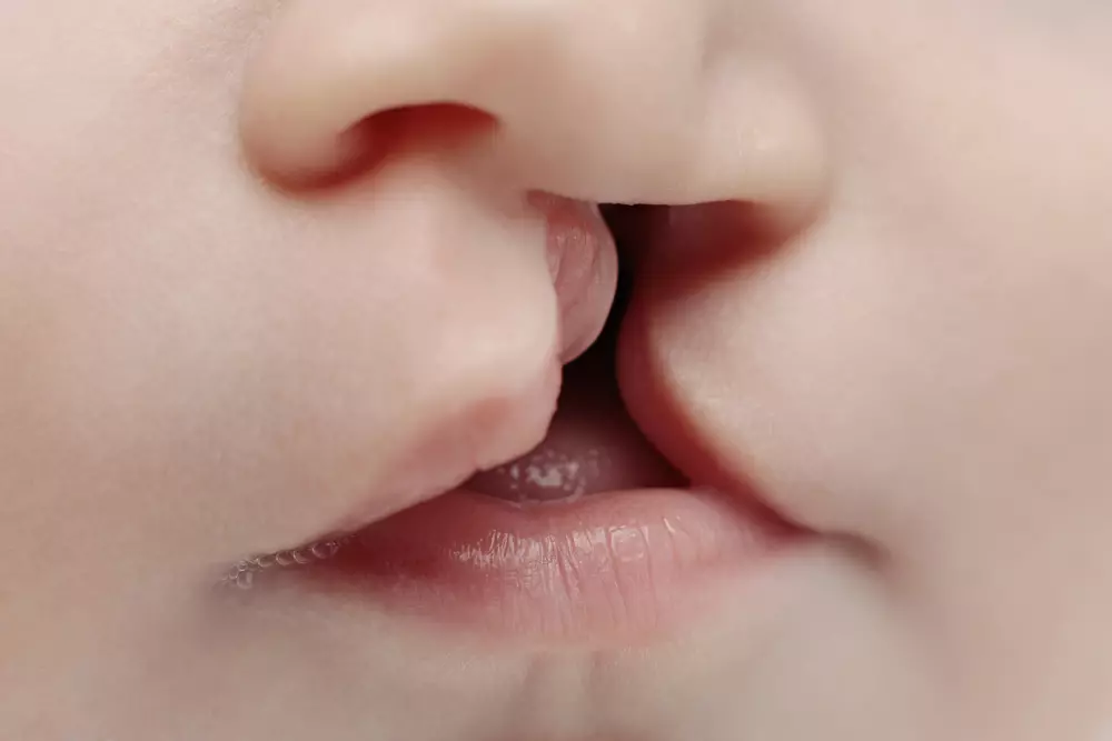 Bibir sumbing: adakah mungkin untuk mencegah dan menyembuhkan patologi