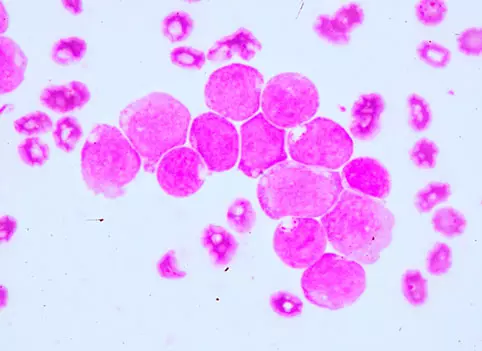 Leucemia mieloide aguda e síndromes mielodisplásicas em adultos 9213_1