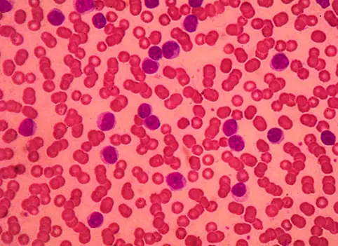 Cov kab mob lymphocytic leukemia ntev (CLL) 9260_1