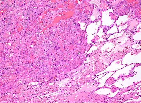 Malignant pleural Mesotheliom 9262_1