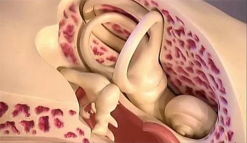 Otosclerosis: ihe na -akpata ntị ntị