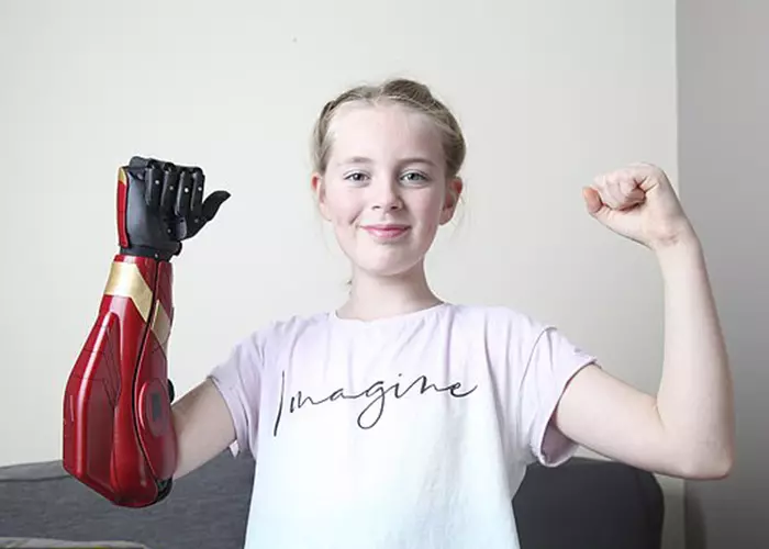 "Äntligen kände jag mig hel": 11-årig engelsk kvinna fick en bionisk hand