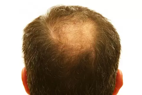 Plešatost mužského typu (androgenetická alopecie) 9937_2