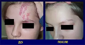 How to get rid of birthmarks 9956_4